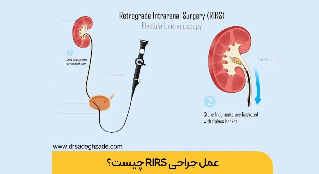عمل RIRS چیست و چه سنگ هایی را از بین می برد؟ | دکتر صادق زاده